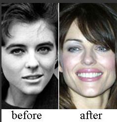 Elizabeth Hurley Surgery
