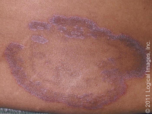 ASK DIS: Tinea Corporis Treatment