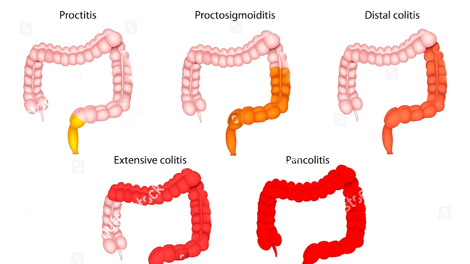 Types Of Ulcerative Colitis - Ulcer Choices