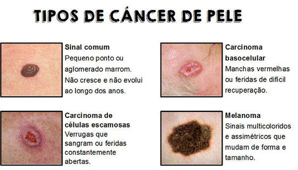 Terapia Fotodinâmica Para O Tratamento De Câncer De Pele Physicsandhealth