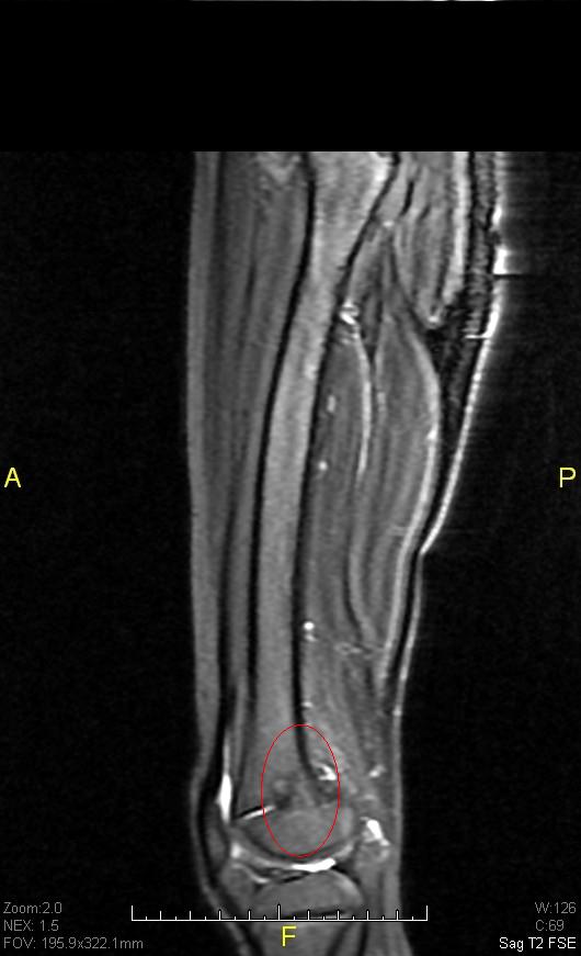 Physeal bar-Plain film & MRI - Sumer's Radiology Blog