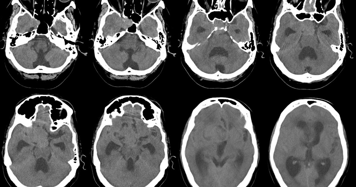 Neuroradiology Cases: Sellar Suprasellar mass DDs