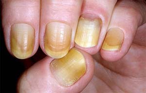 Nails and Your Health | Nurselk.com