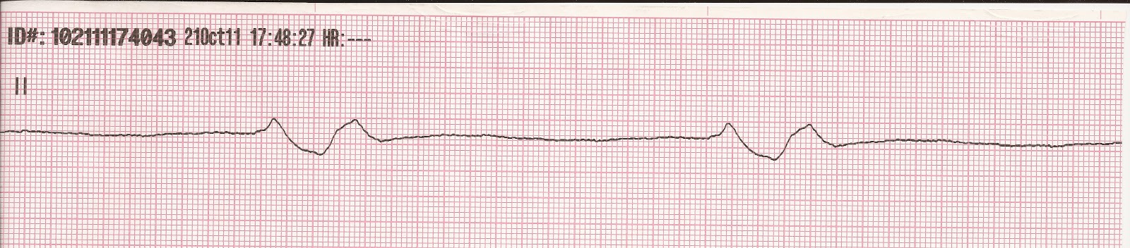 ACLS Rhythms: Ventricular rhythms