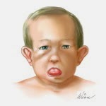 Medical Treatment Pictures-for Better Understanding: DiGeorge Syndrome