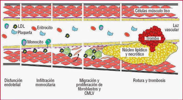 Patología B: Formación de la placa de ateroma