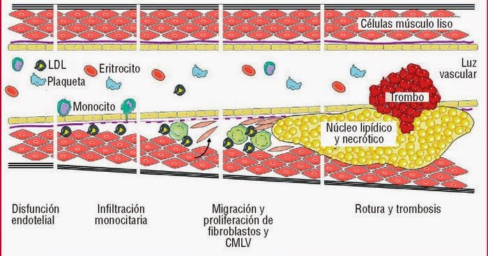 Patología B: Formación de la placa de ateroma