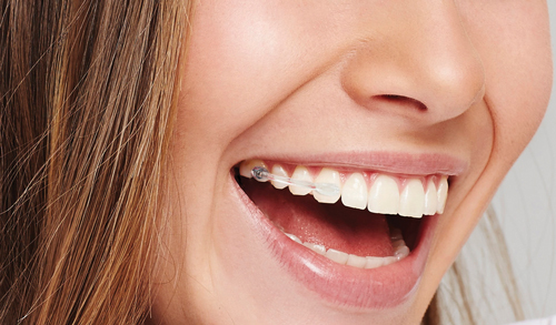 Carriere Motion Appliance