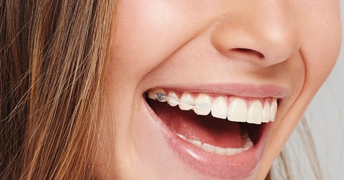 Carriere Motion Appliance