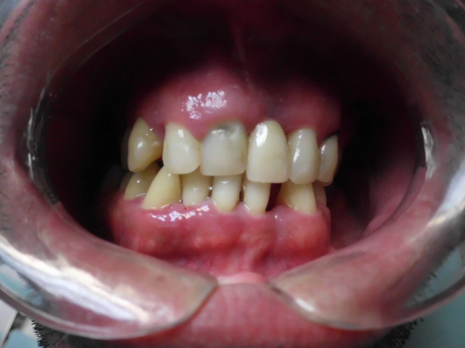 Clinical Report: Retratamiento Endodontico