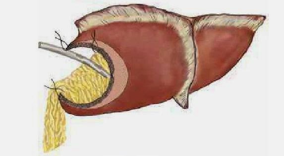 Revision Casos De Cirugia General: QUISTE HEPATICO HIDATIDICO ...