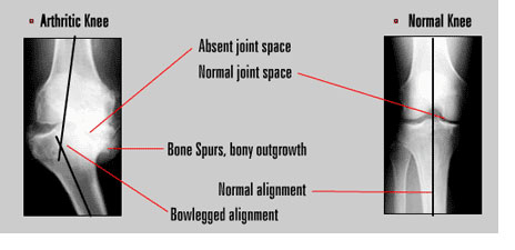 Medical Treatment and Surgery in India with We Care India: Bilateral ...