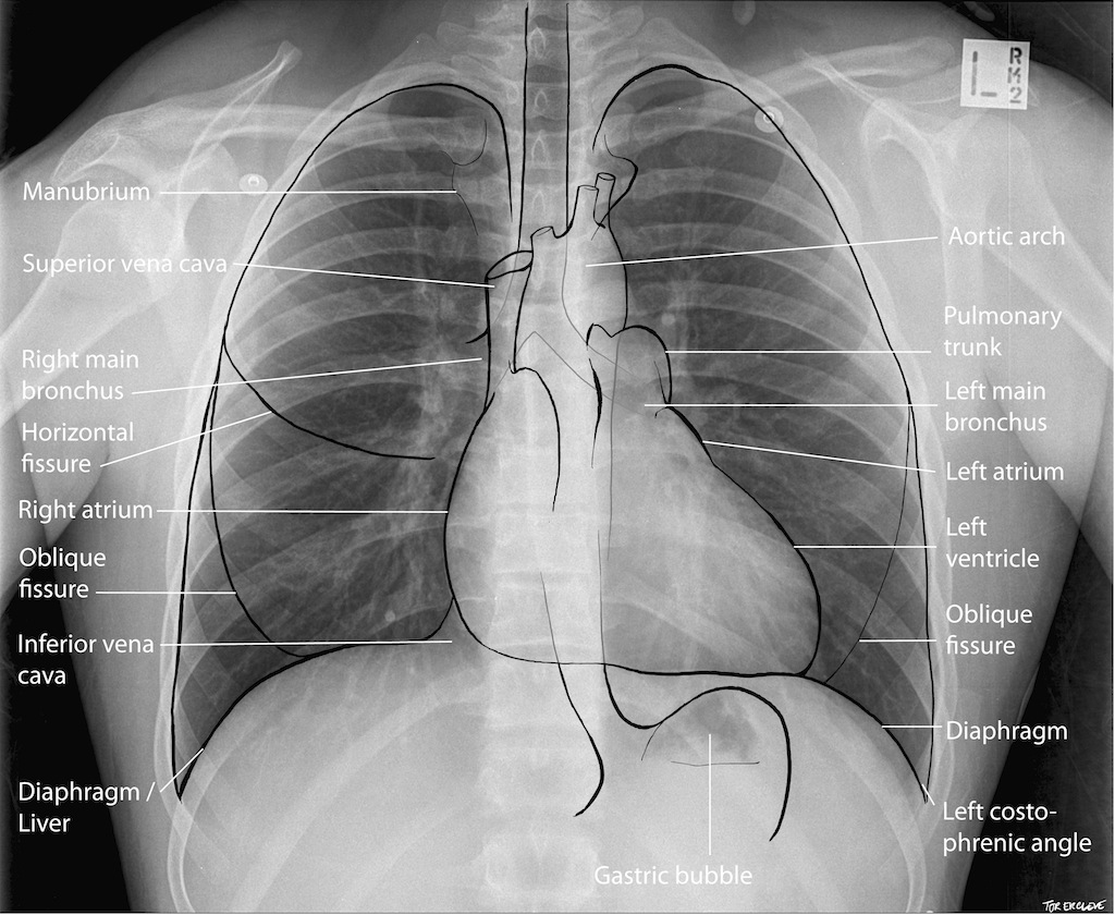 X-ray dada @ chest x-ray - LADY NADIA : MALAYSIAN BLOGGER