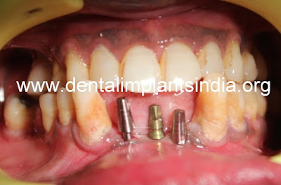 Chinthamani Laser Dental Clinic: REPLACEMENT OF MISSING LOWER FRONT ...