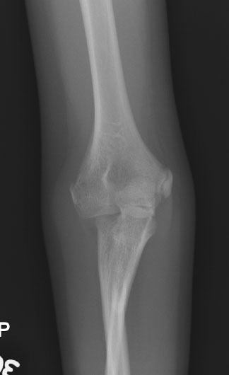 Radioulnar Synostosis, revisited | Congenital Hand and Arm Differences ...