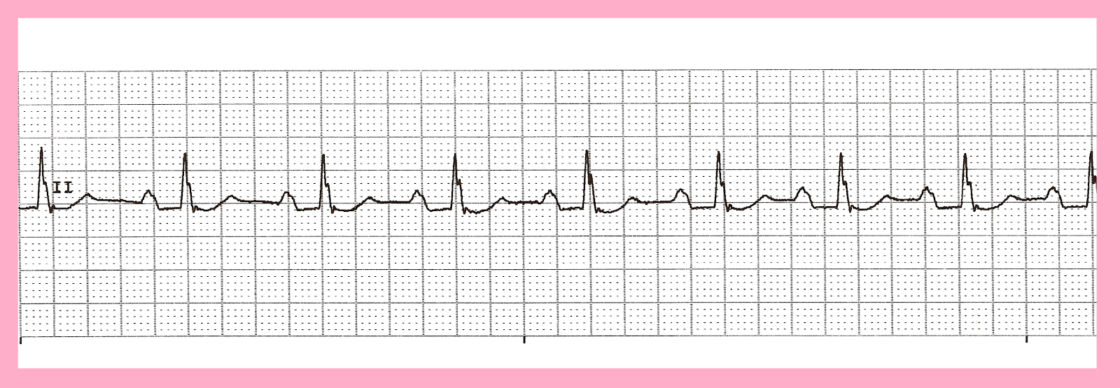 EKG Rhythm Quiz 271