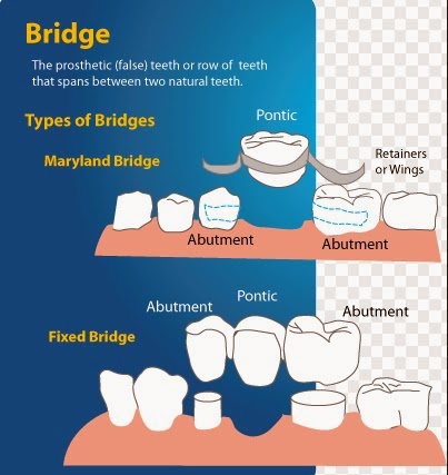 Omni Dental Group: Maryland Bridge (Bonded Resin Retainer)