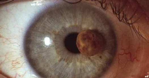 What Is Eye Cancer Treatment - Is There A Cure For Eye Cancer? - what ...