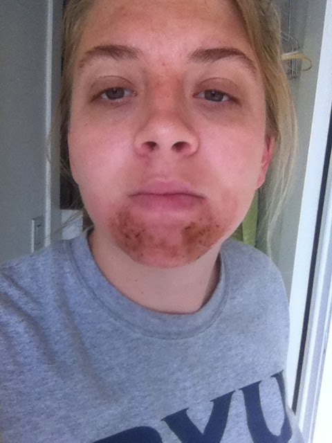 Jessica Mae: Melaleuca Oil Skin Burn