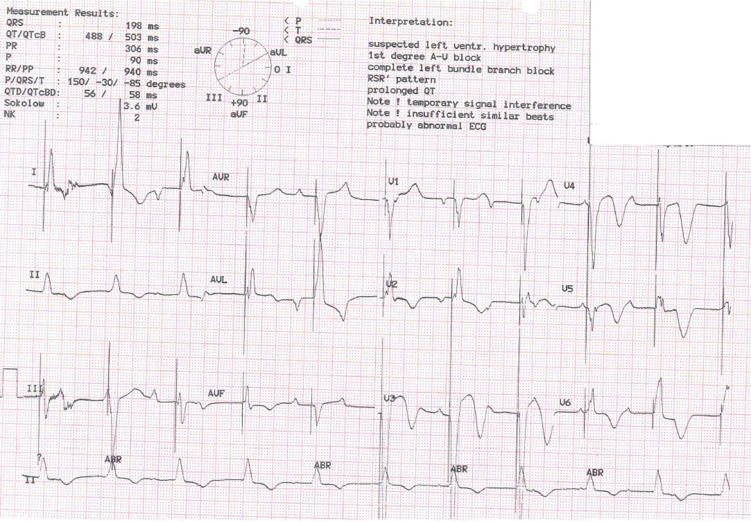 Dr. Smith's ECG Blog: Giant Inverted T waves in an Elderly Patient