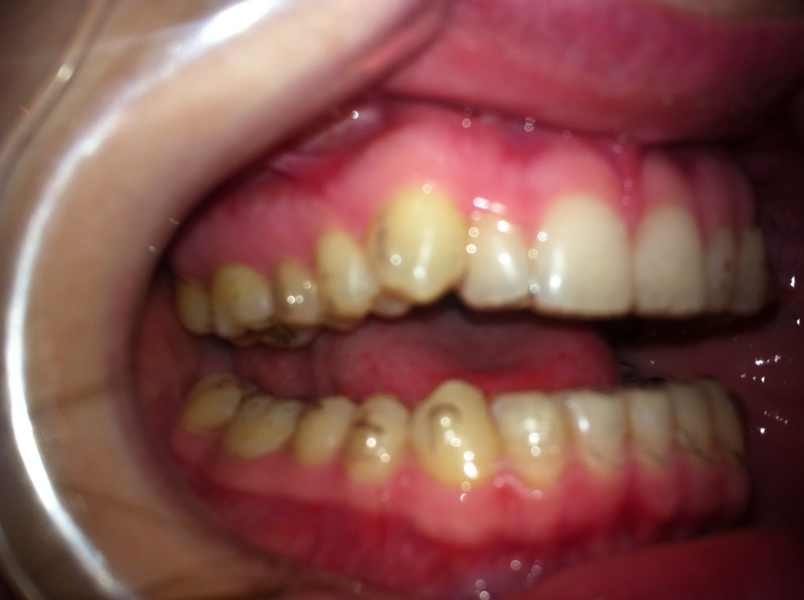 Shona's Invisalign Blog: First day with Invisalign / Pictures with ...