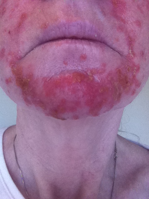 Just Thoughts on a Blog: My Skin Cancer Journal