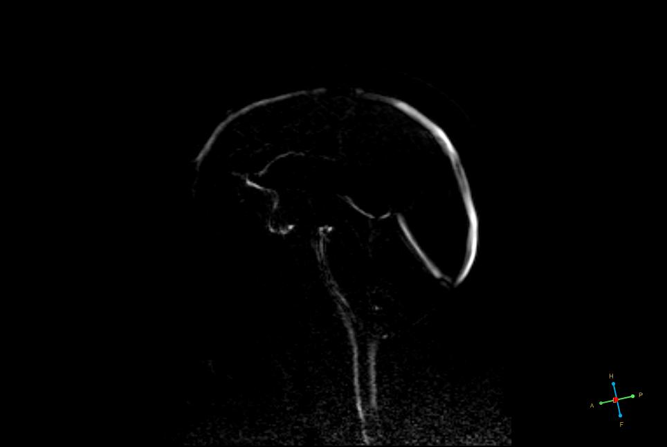 NPH and CSF flow studies - Radiology Imaging