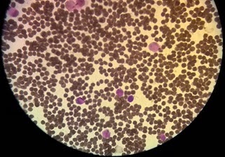 Cuaderno de Prácticas de Hematologia: TINCIÓN DE GIEMSA