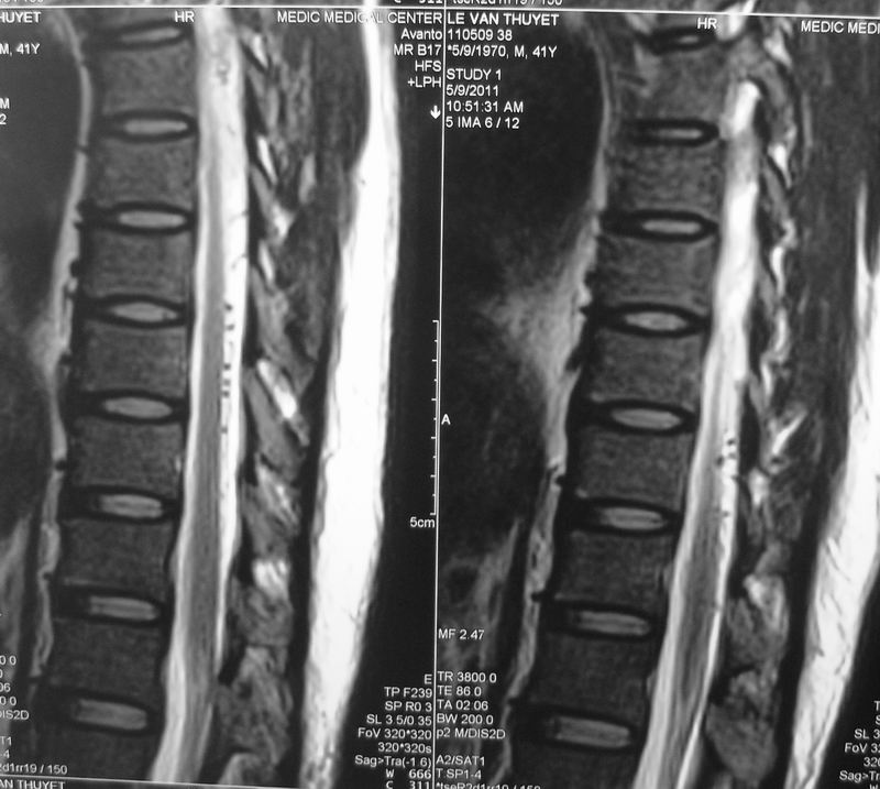MRI MEDIC CASE STUDIES COLLECTION: SPINAL AVM