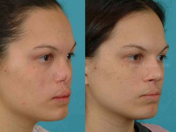 Dr. Dean Toriumi Reviews: Dean Toriumi: Cleft Lip and Reconstructive ...