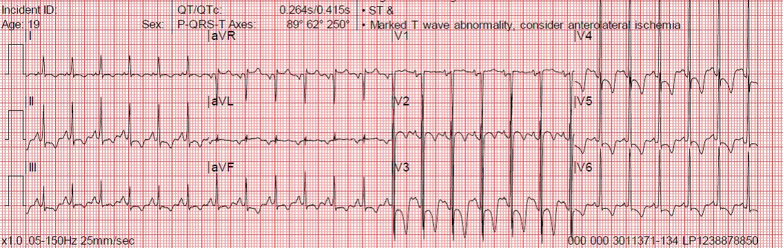 ECGs for EMS: LVH, Strain, Ischemia, or What?