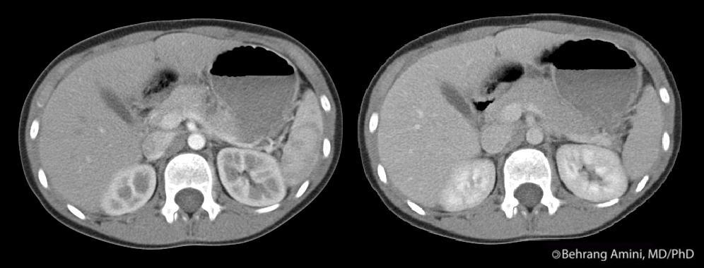 Roentgen Ray Reader: Heterogeneous Splenic Enhancement in Children