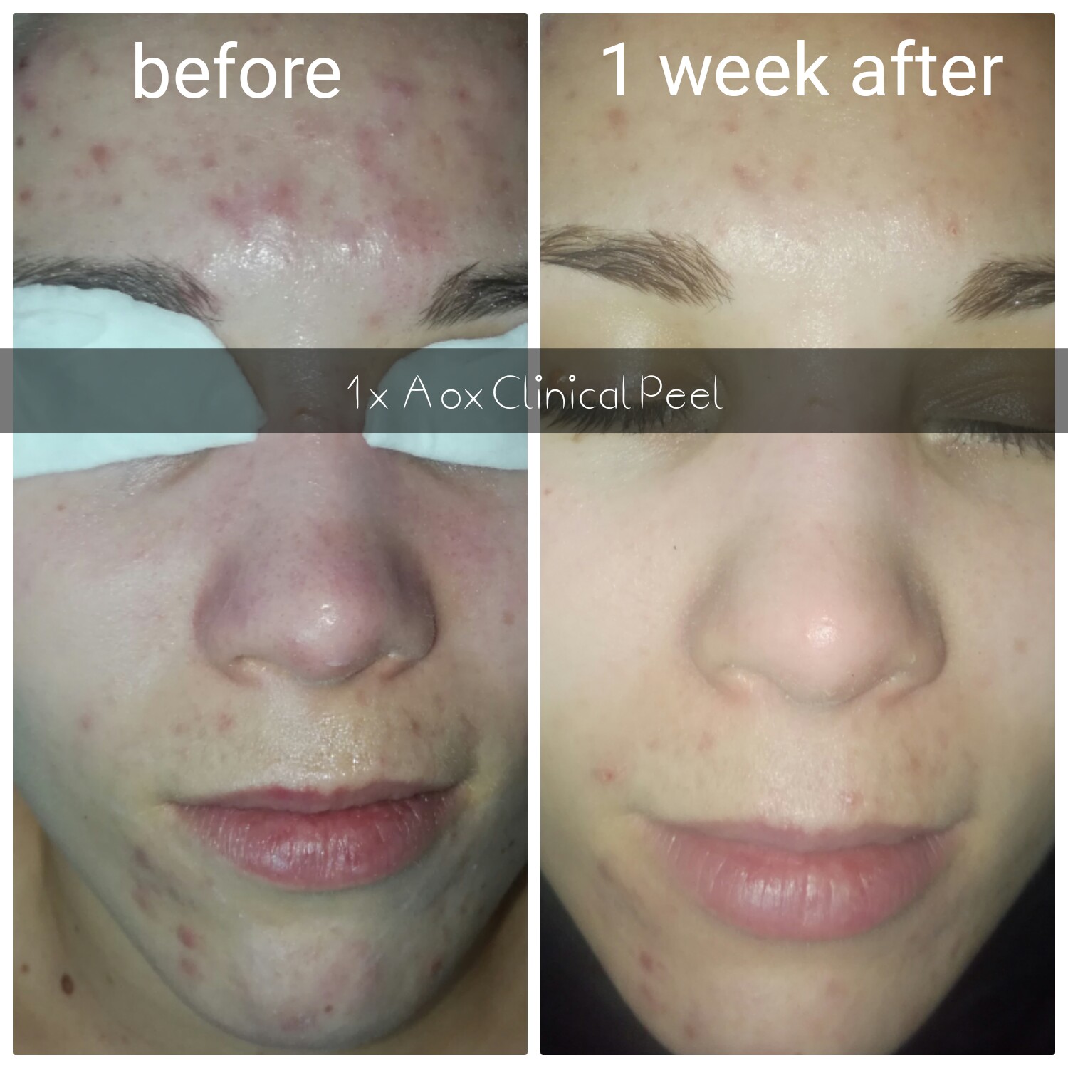 Between The Bassline: AOX SYSTEM - New Generation Chemical Peel