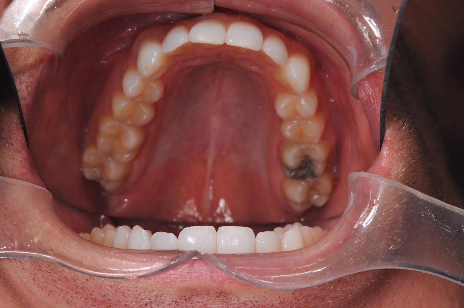 Intraoral Photos Dental at Sandra Slavin blog