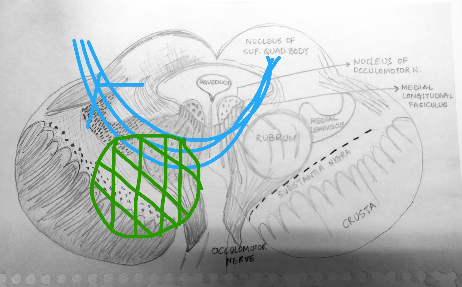 Medicowesome: Brainstem syndromes-Midbrain!
