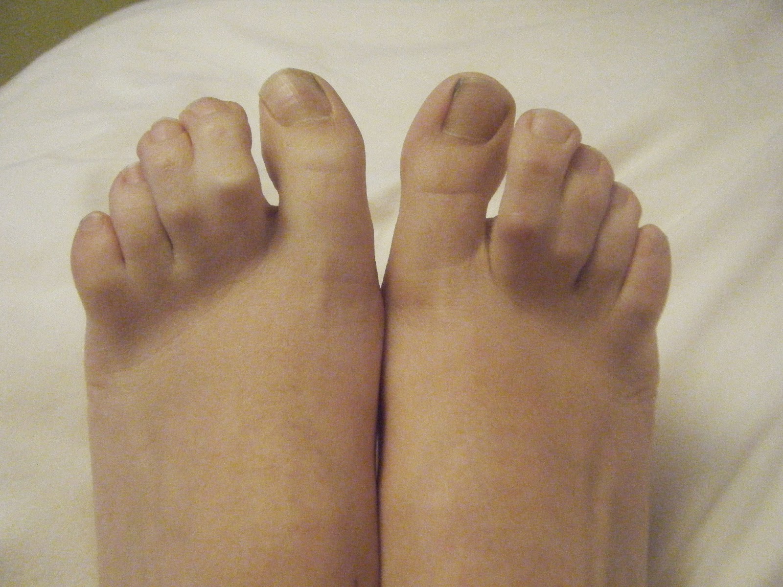 Syndactyly separation