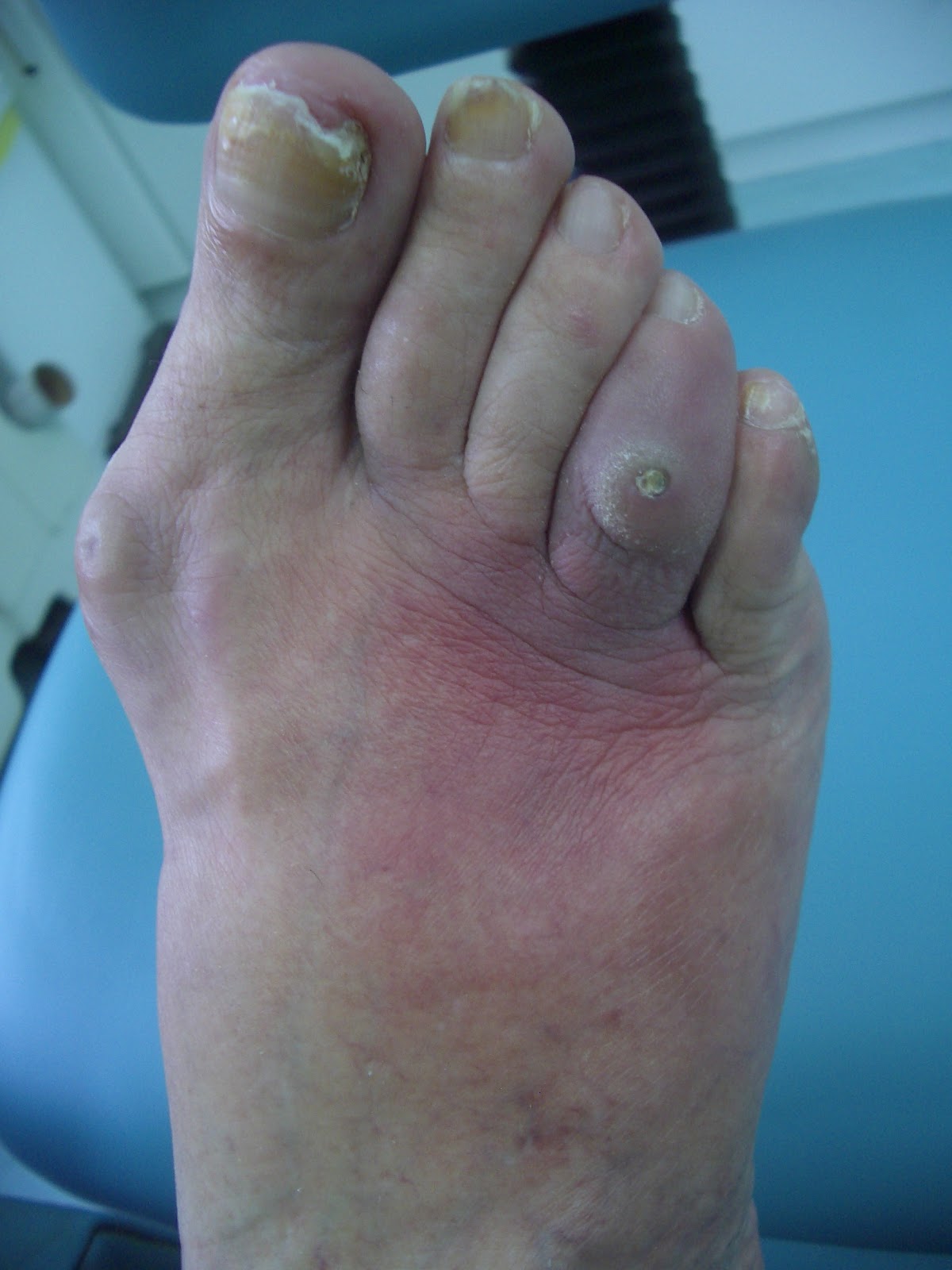 Podo Basas al Día: Infección con celulitis. Pies valgos. Dolor en ...