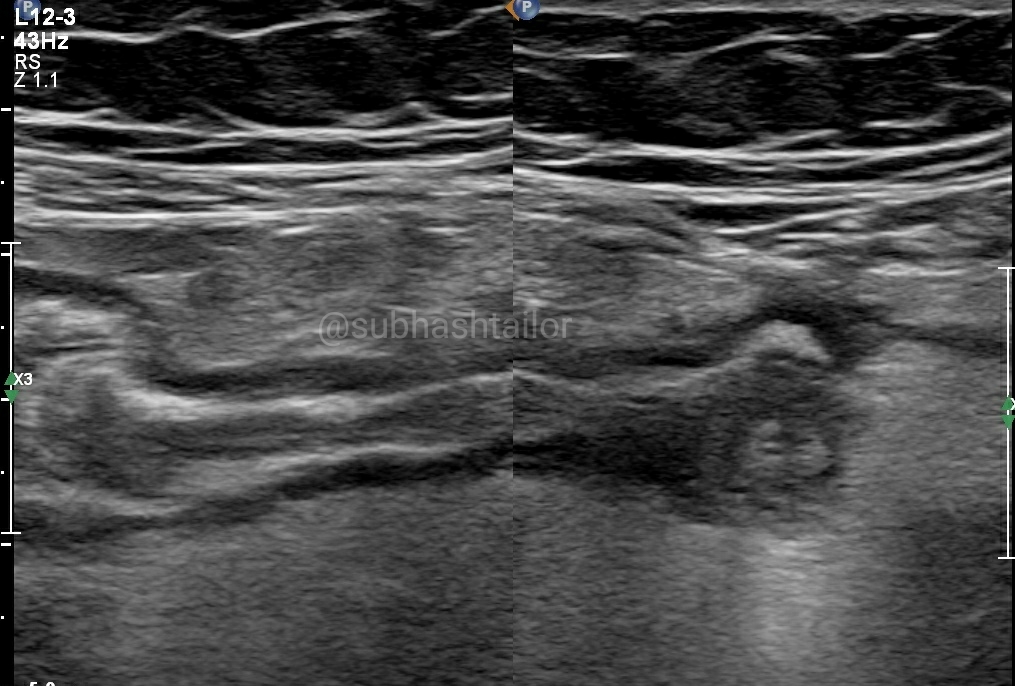 SONO DIGEST: APPENDICITIS WITH PERFORATION AT TIP