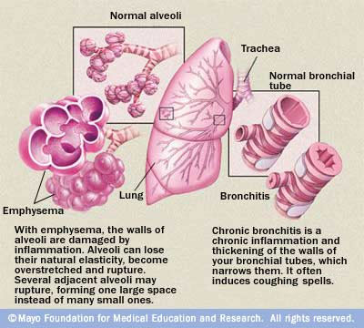 Tervisest: Emfüseem ja krooniline bronhiit