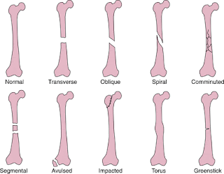 Medische Kennis: Fractuurleer: fractuurtypen
