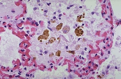 Biometria Hematica!!(:: Hemosiderina :)