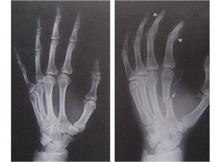 angelesrx.smp: Mano PROYECCION OBLICUA