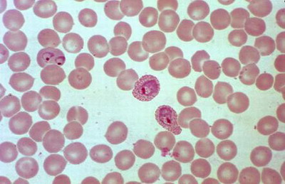 What Is Normocytic Anemia