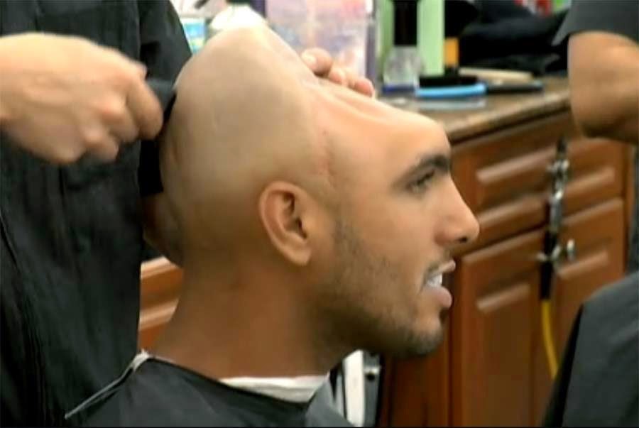 Understanding The Implications Of Removing Half The Brain: A ...