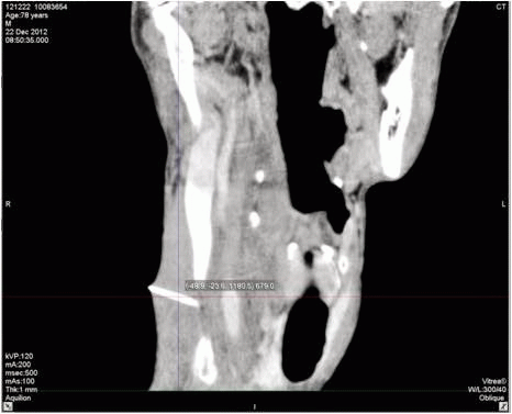 VIETNAMESE MEDIC ULTRASOUND: CASE 313: FISH BONE APPEARING in NECK, Dr ...