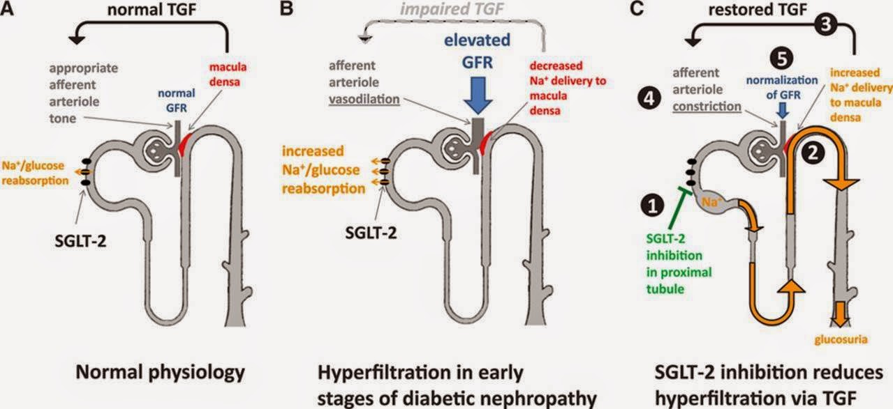 Renal Fellow Network: SGLT-2 and the genesis of hyperfiltration