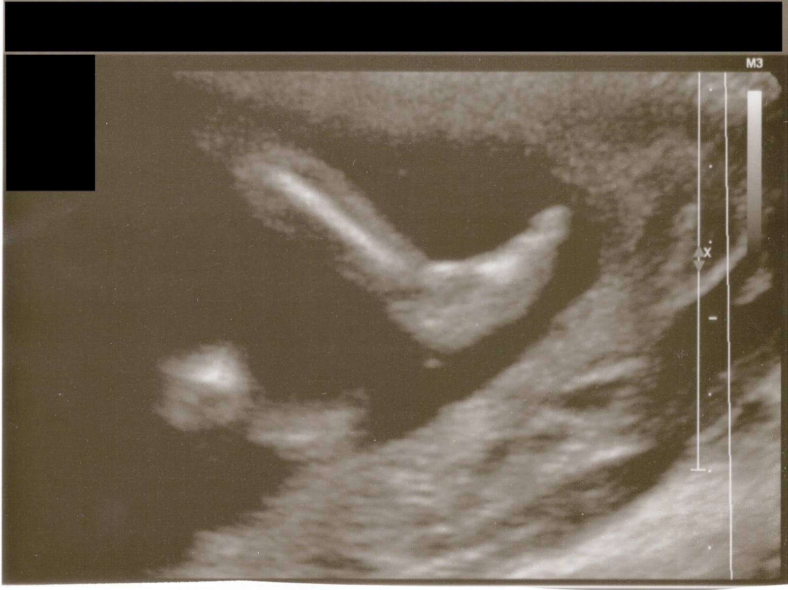 Our Journey through Embryo Adoption!: 18 week update