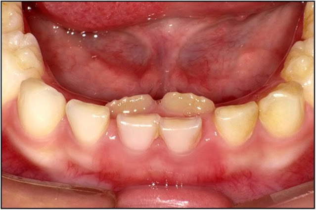PDF: Management of the Developing Dentition and Occlusion in Pediatric ...