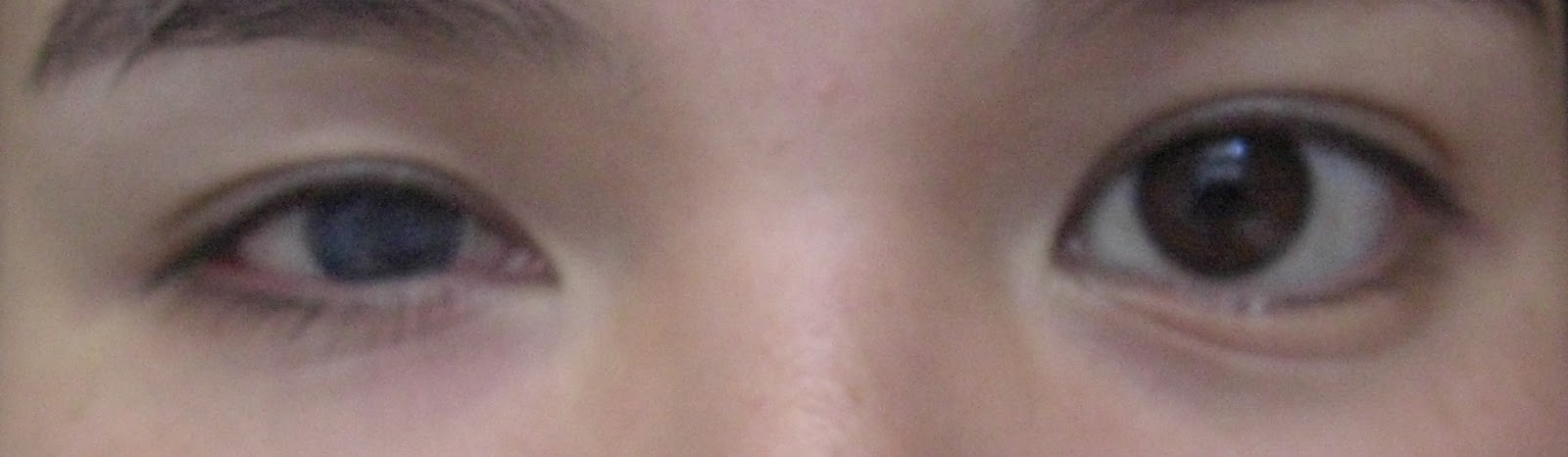 ¿Qué es la Microftalmia?