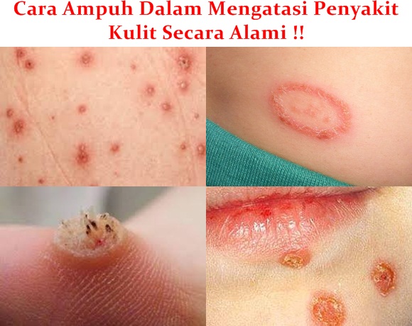 Jenis - Jenis Penyakit Kulit Dan Cara Mengobatinya ~ Obat Tradisional ...
